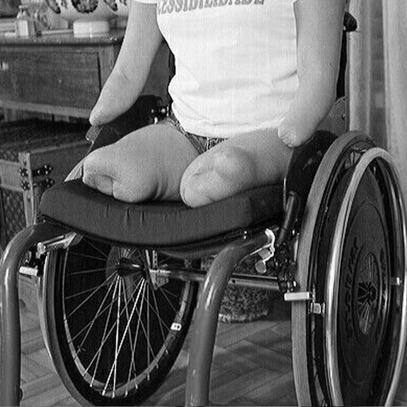 We’re Not Stumped Amputee Categories